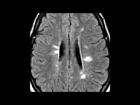 EMP ¿What is Multiple Sclerosis?