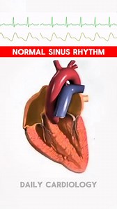Ventricular Tachycardia to Normal Sinus Rhythm #reelschallenge #short #ECG #ventriculartachycardia #HeartAnimation #hearthealth | Daily Cardiology