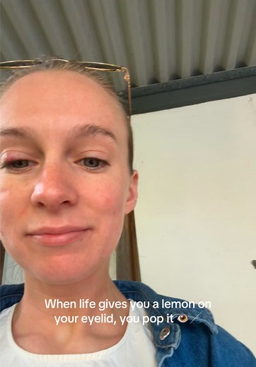 Eyelid Stye Removal: When Life Gives You Lemons
