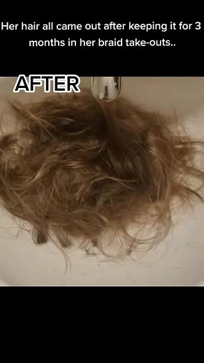 White Girl's Braiding Disaster: Hair Loss After Braids