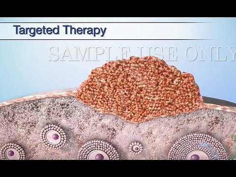 Treatment Options for Ovarian Cancer