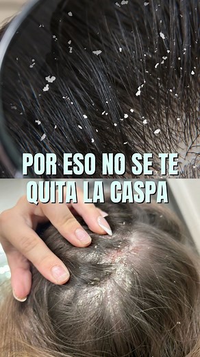 ¿Tienes caspa y no se te quita por nada? ❄️😣 Te cuento por qué. 👇 Muchos creen que lavarse el cabello a diario empeora la caspa… pero es todo lo contrario. 🚿✨ La caspa es una mezcla de sebo escamas que, si no la limpias todos los días, se acumula y causa más inflamación. 🔥 Por eso es clave usar un shampoo adecuado 🧴✔️ Busca uno con ingredientes que reduzcan la inflamación y ayuden a eliminar la escama como Kelual DS. También puedes usar Ketocon Bio y lavar siempre con agua templada o fría ❄