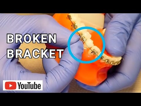 Broken Braces: Broken, Loose or Sliding Bracket| What To Do!