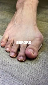 From Bunion + Second Toe Deformity to a Straight, Beautiful Foot — All Without Big Incisions