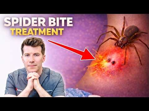 Spider Bite Treatment: When It’s Harmless vs Dangerous