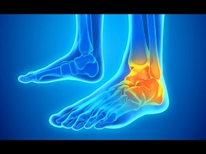FMT and Inversion Ankle Sprains