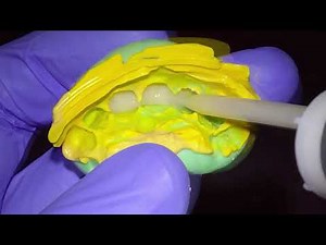 Infected Tooth Removal and Bridge Replacement