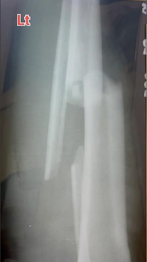 X-ray of leg (tibia and fibula) Ap/Lt view Position Radiology