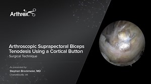 Arthroscopic Suprapectoral Biceps Tenodesis Using a Cortical Button