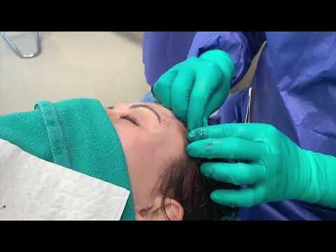 Dr. DuPéré LIVE Surgery: Temporal Lift