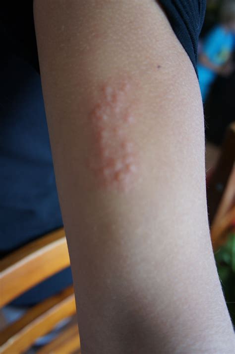 Itchy Red Rash On Upper Arm Printable Templates Free