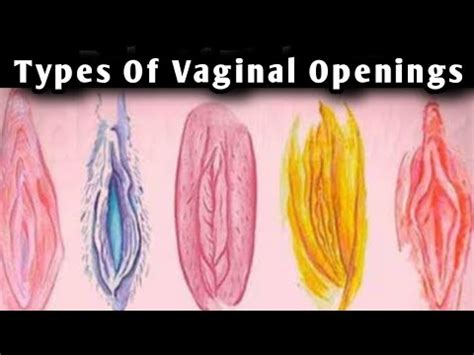Types Of Vaginal Openings YouTube