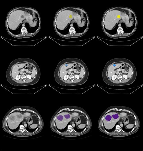 liver lesion segmentation and classification results left original download scientific
