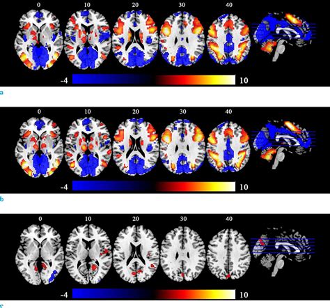 attention and working memory task load dependent activation increase with deactivation decrease