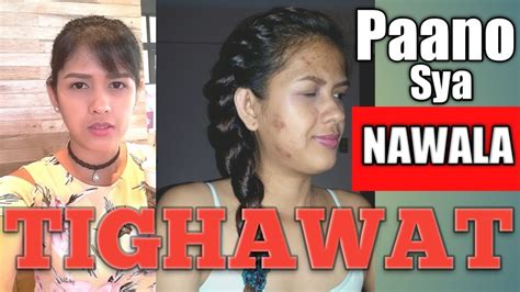 How To Remove Tigyawat Or Pimples Solusyon Sa Pimples Tips Tricks