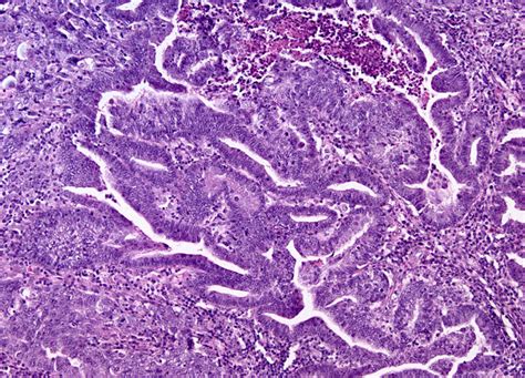 Endometrial Carcinoma Histology