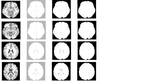 medical image segmentation of improved genetic algorithm research based on dictionary learning