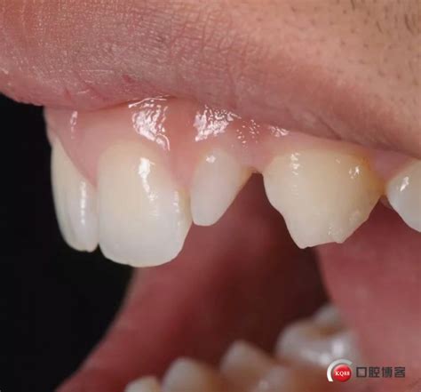 病例分享17岁男性左上侧切畸形牙树脂美学修复病例 广东快全的博客 KQ88口腔博客