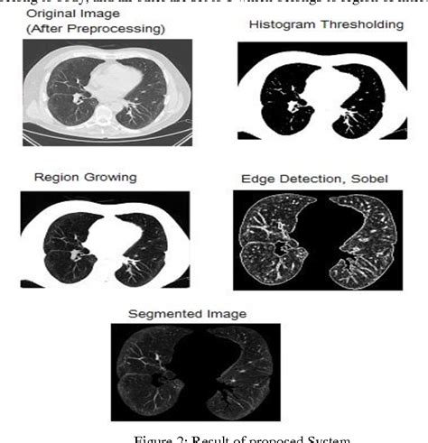 figure 2 from lung segmentation using region growing algorithm semantic scholar