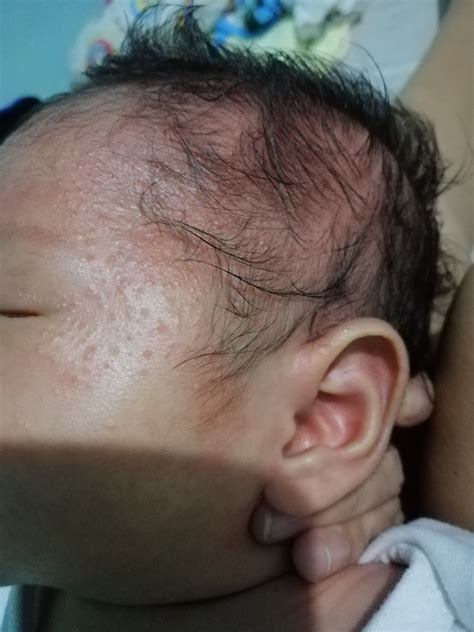 Maliliit Na Butlig Sa Mukha Ng Baby Mukha Sumikat