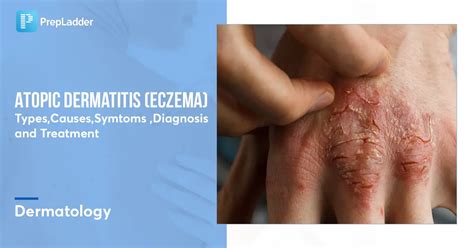 Atopic Dermatitis Eczema Types Causes Symptoms Diagnosis And Treatment Dermatology
