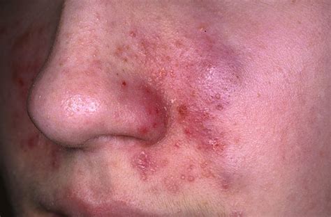 Seborrheic Dermatitis Symptoms Causes And Other Risk Factors