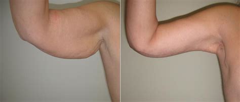 Weight Loss Surgery Tattoo Ideas