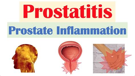 Prostatitis Prostate Inflammation Different Types Causes Signs And Symptoms Diagnosis Treatment