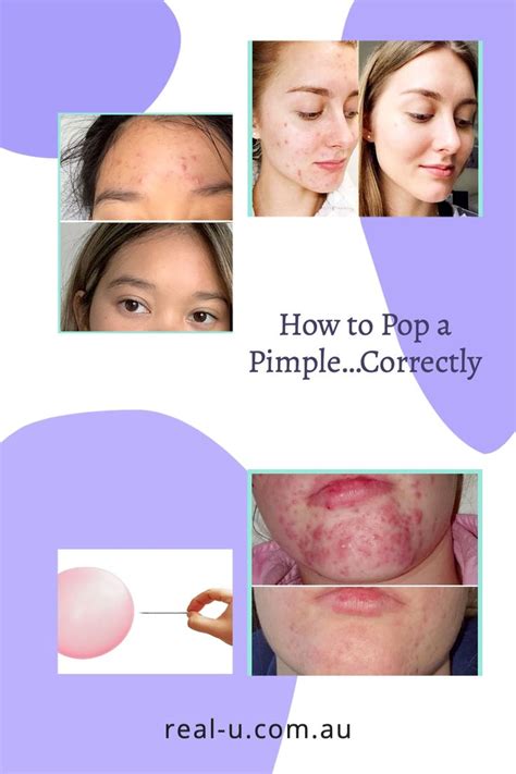 HOW TO POP A PIMPLE CORRECTLY Pimples Painful Pimple Skin Care