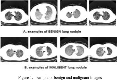 figure 1 from lung nodules detection and classification using convolution neural network