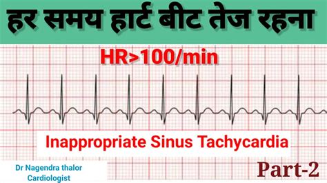 Fast heart beat l Inappropriate Sinus Tachycardia फसट हरट बट