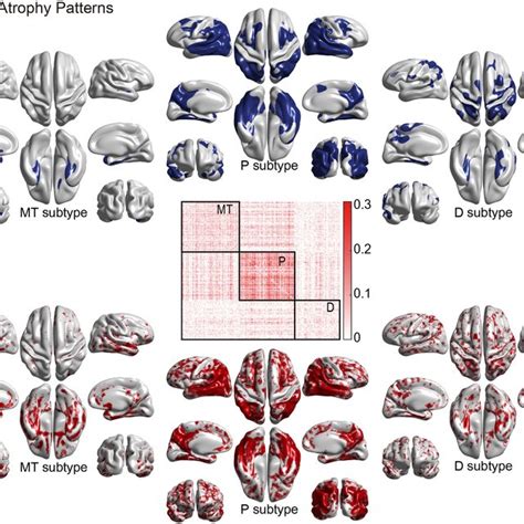 cortical atrophy patterns for three ad subtypes using the smc dataset download scientific
