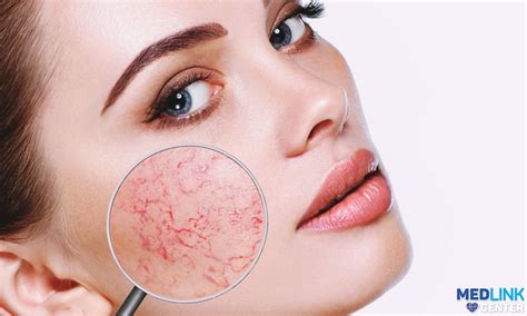 Rozaceea cauze manifestare și sfatul dermatologului Clinica Medlink