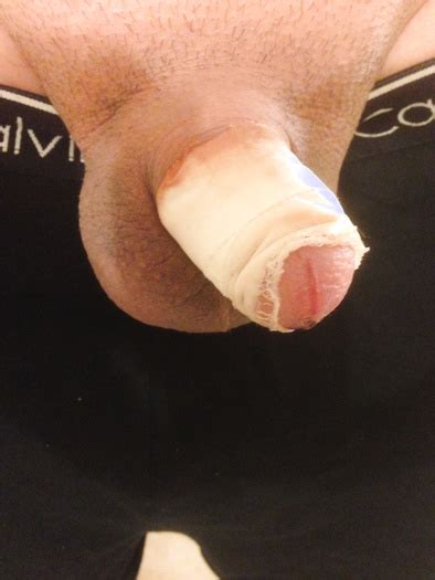 Before And After Circumcision Image 3214963 Thisvid Tube