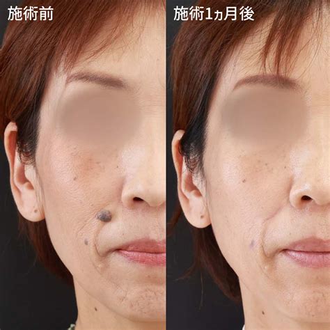 目立つホクロを改善したい！痕の残りにくい治療法をtaクリニックで安心安全に。｜症例写真・ビフォーアフター｜美容整形･美容外科のtaクリニックグループ