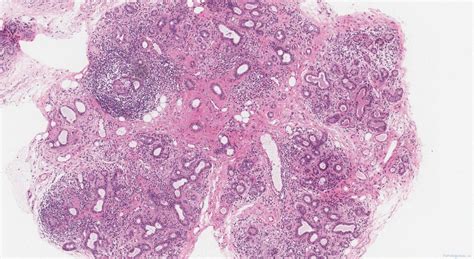 Sjogrens Disease Of The Salivary Glands Ottawa Atlas Of Pathology