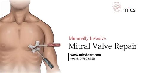 Minimally Invasive Mitral Valve Repair MICS HEART