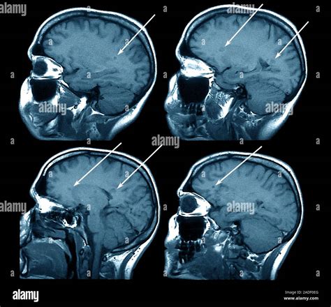 Multiple Sclerosis Coloured Magnetic Resonance Imaging MRI Scans Of