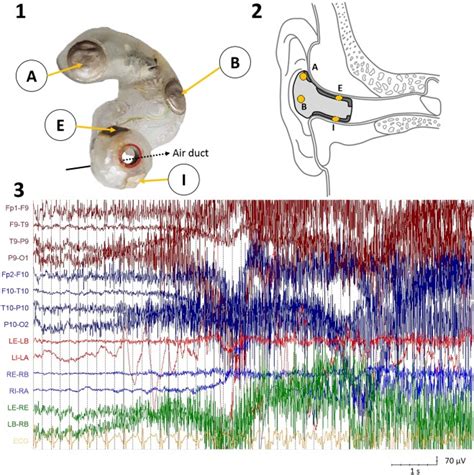 detection of generalized tonic clonic seizures from ear eeg based on emg analysis seizure