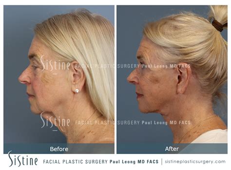 Deep Neck Lift Before And After 01 Sistine Facial Plastic Surgery