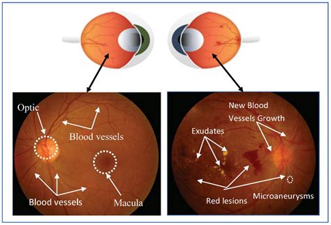 applied sciences free full text automated diabetic retinopathy screening system using hybrid