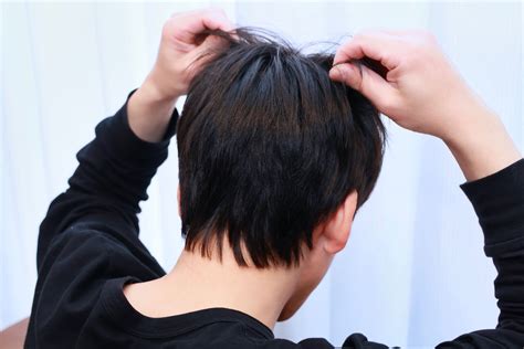つむじはげ思い込み頭頂部の薄毛の見分け方と原因バレにくい画期的な治療法親和クリニック東京名古屋大阪福岡