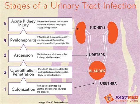 To Know More About Prostatitis Signs Symptoms And Treatment
