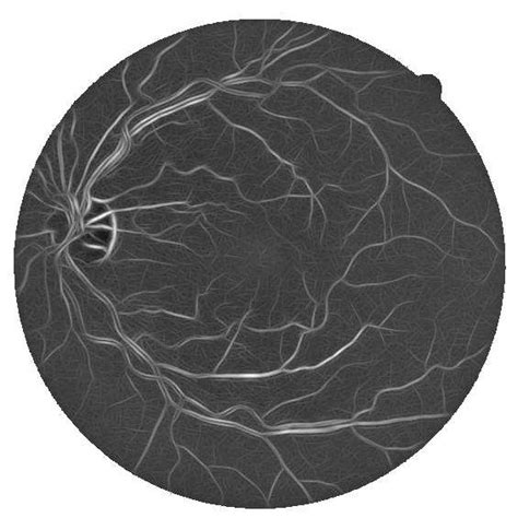 pdf retianl vessel segmentation using the 2 d gabor wavelet and supervised classification