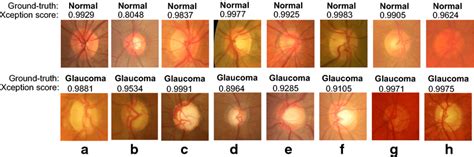 examples of correct normal and glaucoma classification samples of download scientific diagram