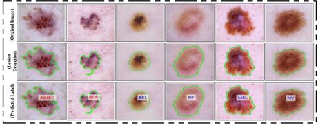 [pdf] skin lesion segmentation and multiclass classification using deep learning features and