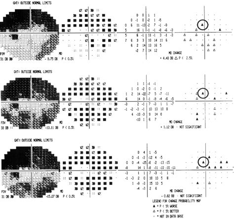 early detection of visual field progression in glaucoma a comparison of progressor and statpac