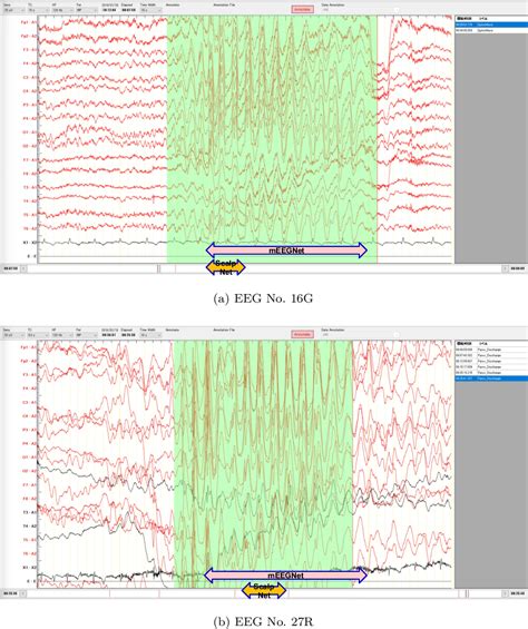 figure 5 from automated detection of abnormalities from an eeg recording of epilepsy patients