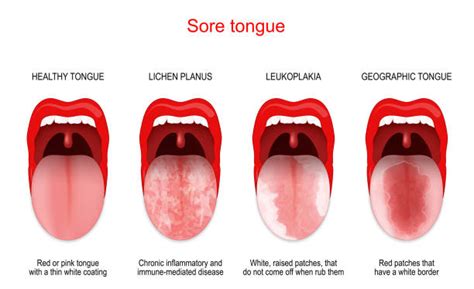 Normal Tongue Vs Thrush
