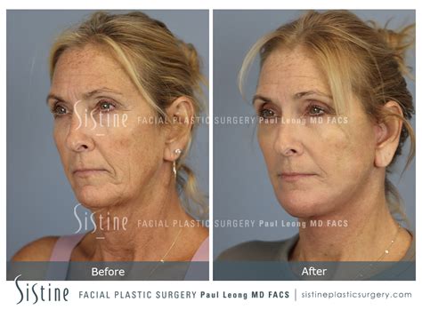 Deep Neck Lift Before And After 04 Sistine Facial Plastic Surgery